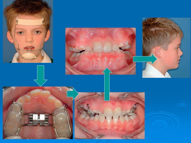 Class III Orthodontics Dentistry by Cezar E. | PDF | Dental Health ...