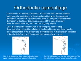 Class III Orthodontics Dentistry by Cezar E. | PDF