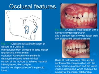 Class III Orthodontics Dentistry by Cezar E. | PDF