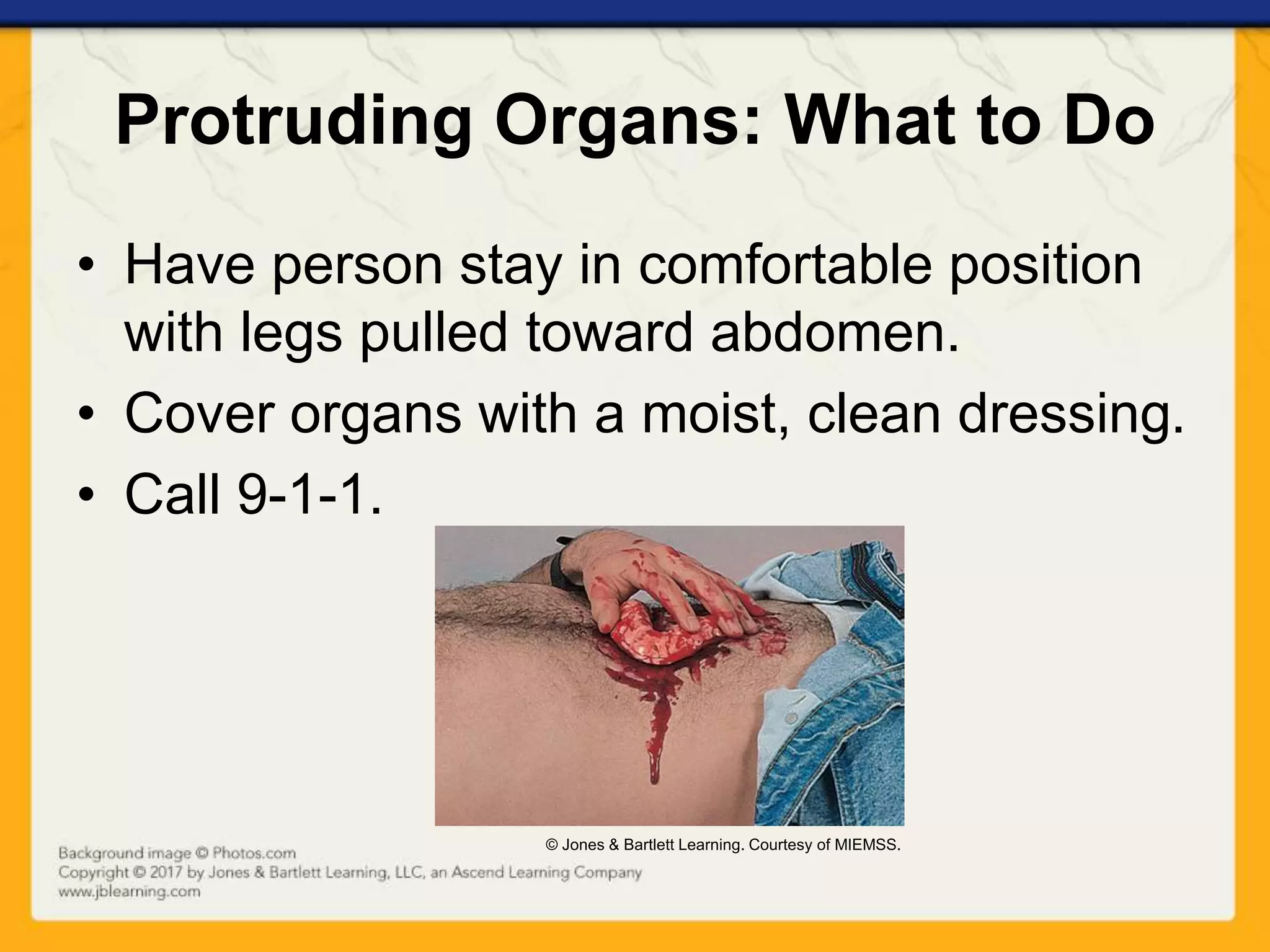 Ch13 presentation chest_abdominal_pelvic_injuries | PPTX