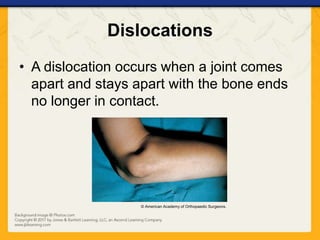 Ch14 presentation bone_joint_muscle_injuries | PPT