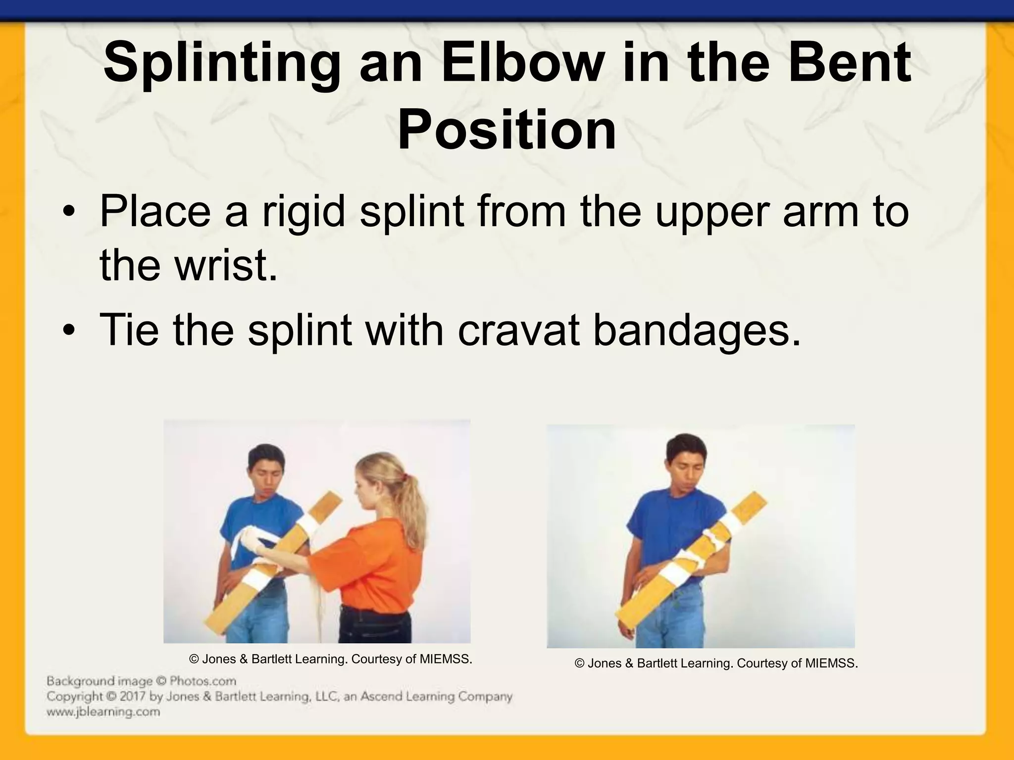 Ch16 presentation splinting_extremities | PPTX