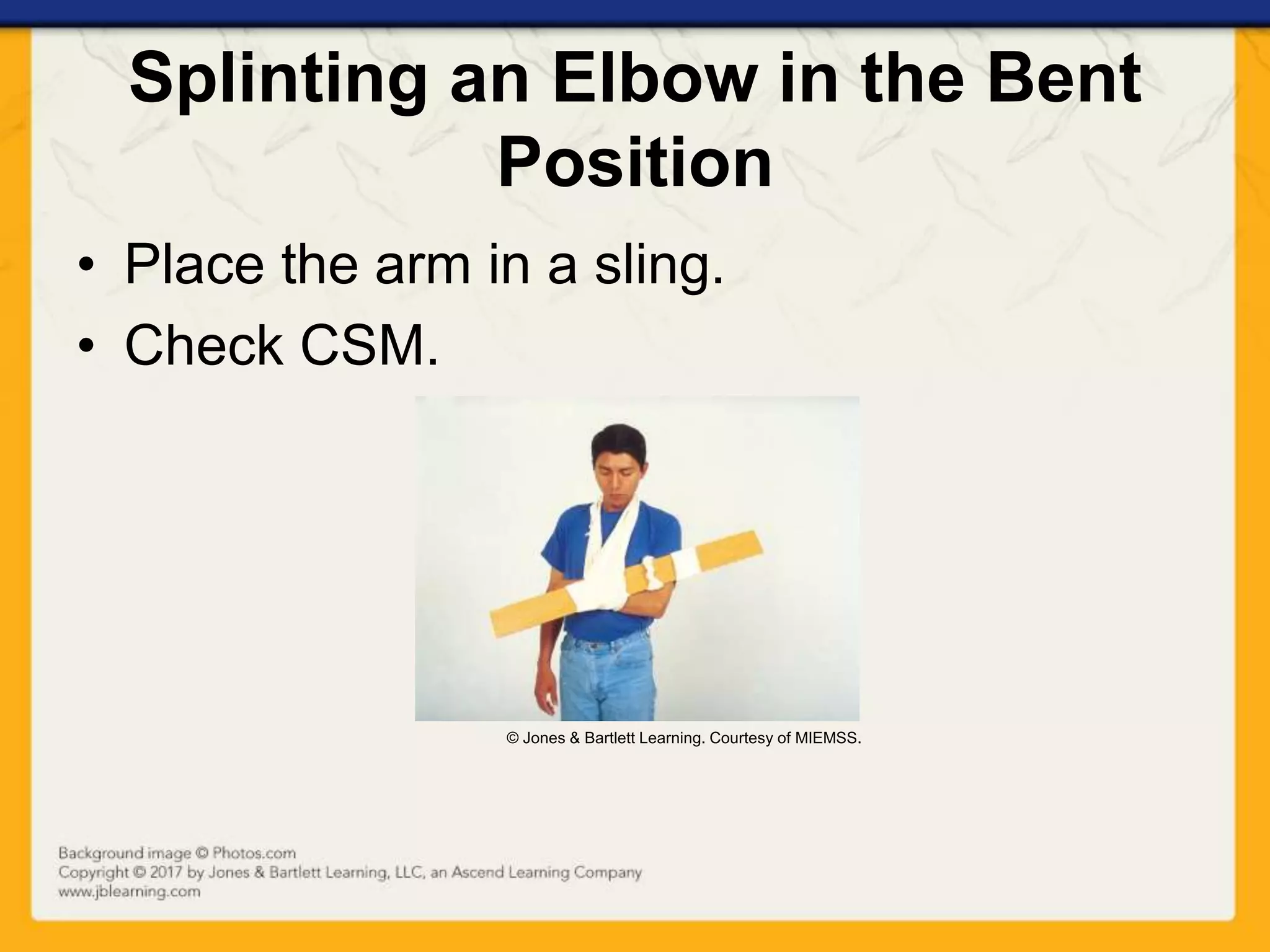 Ch16 presentation splinting_extremities | PPTX