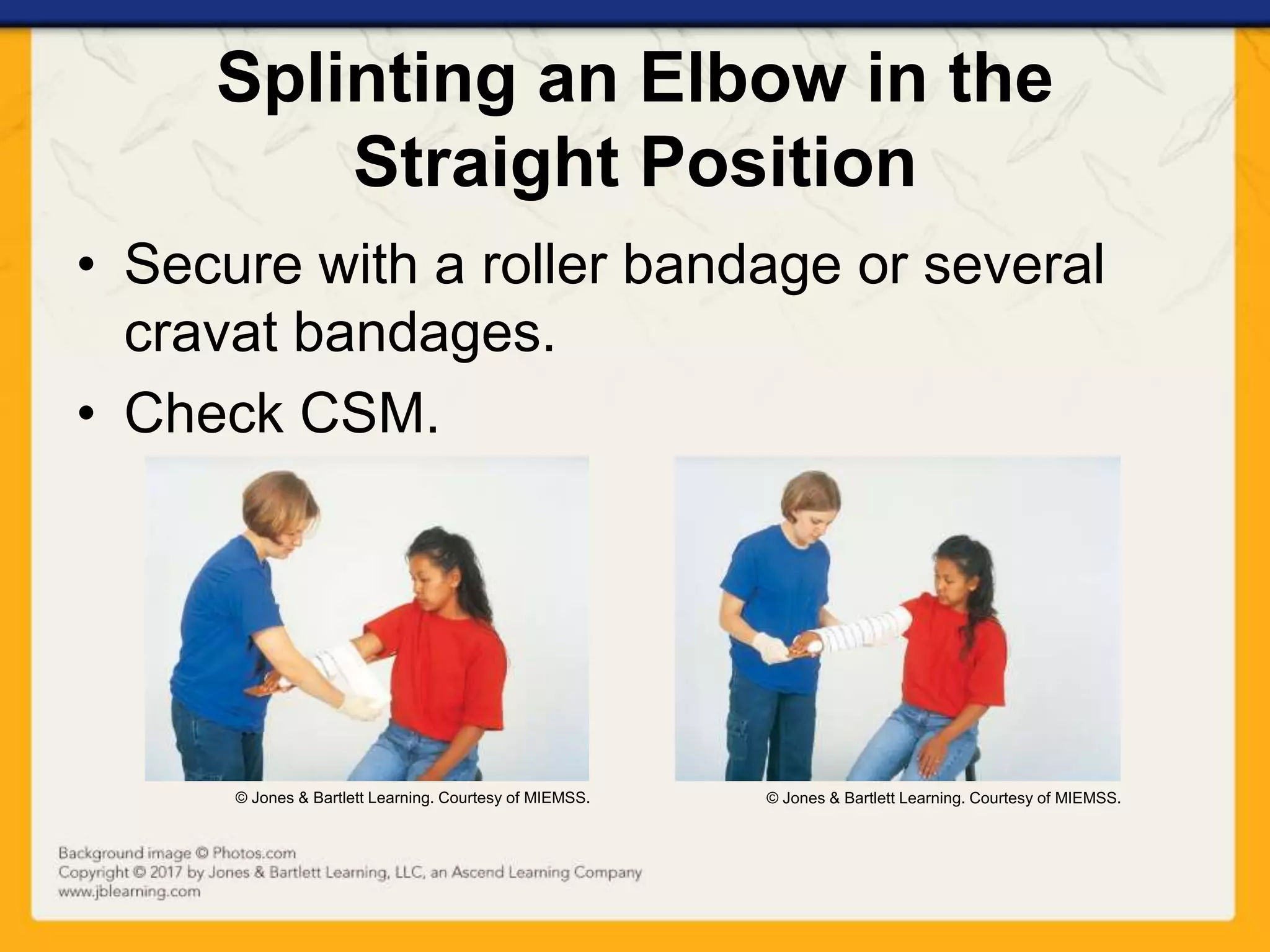 Ch16 presentation splinting_extremities | PPTX