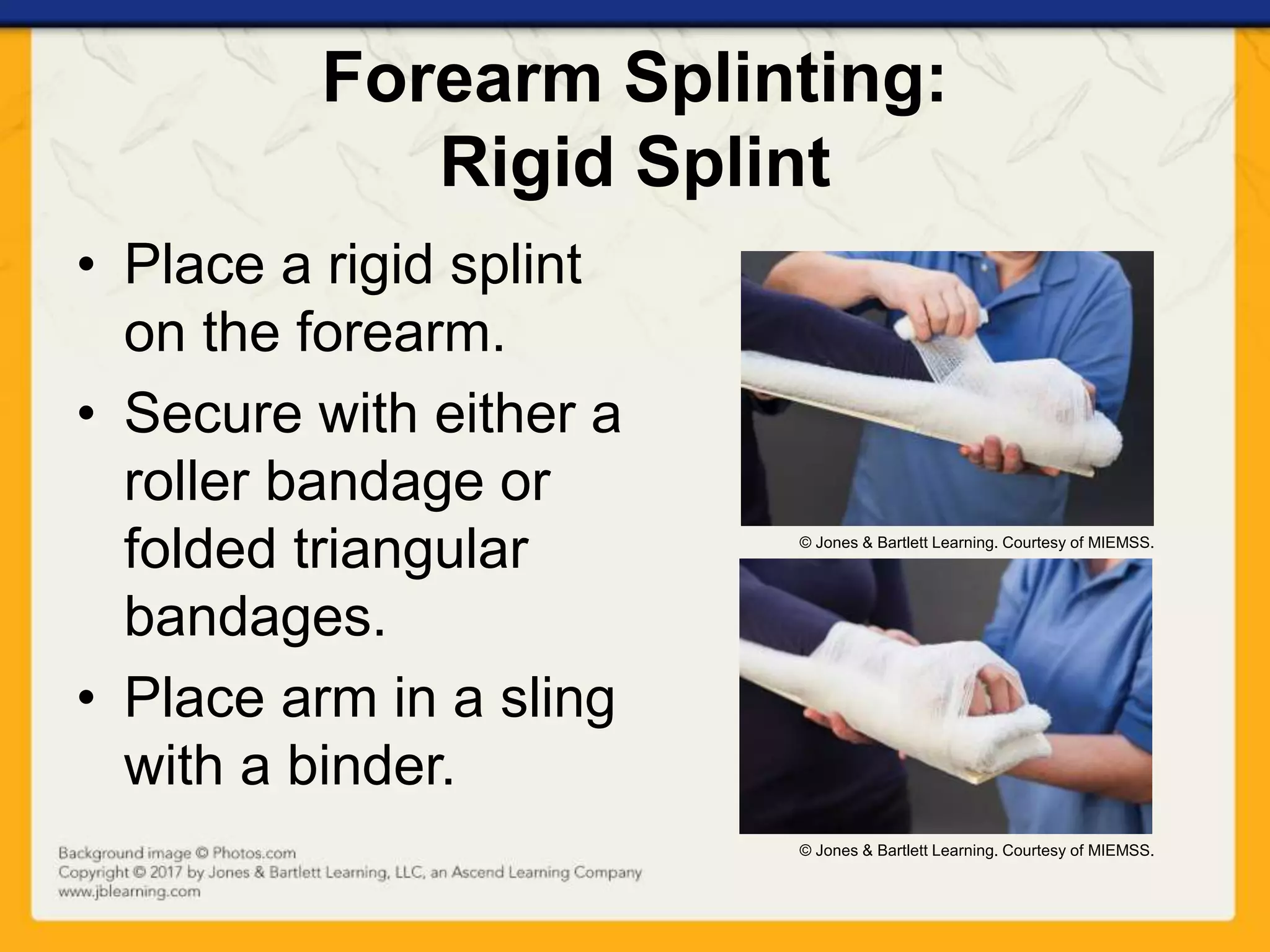 Ch16 presentation splinting_extremities | PPTX