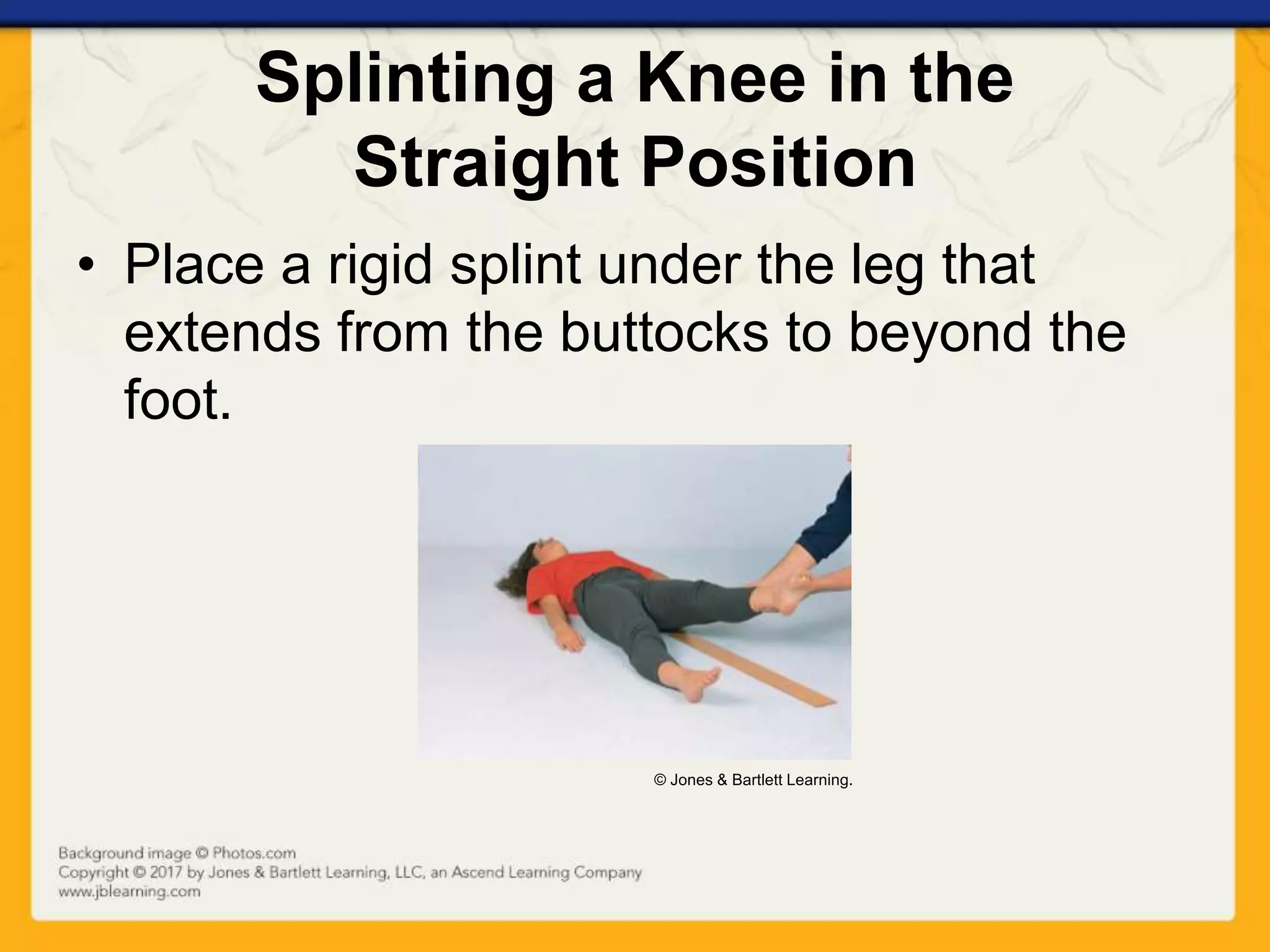 Ch16 presentation splinting_extremities | PPTX