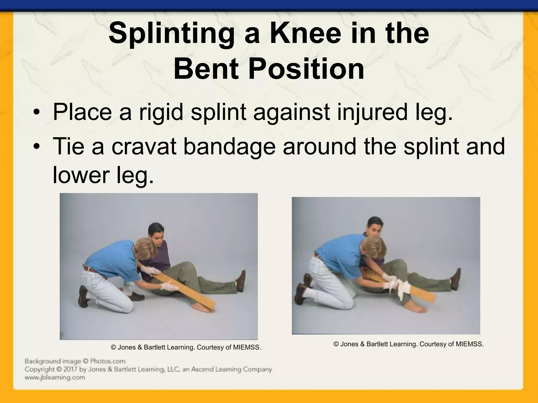 Ch16 presentation splinting_extremities | PPTX
