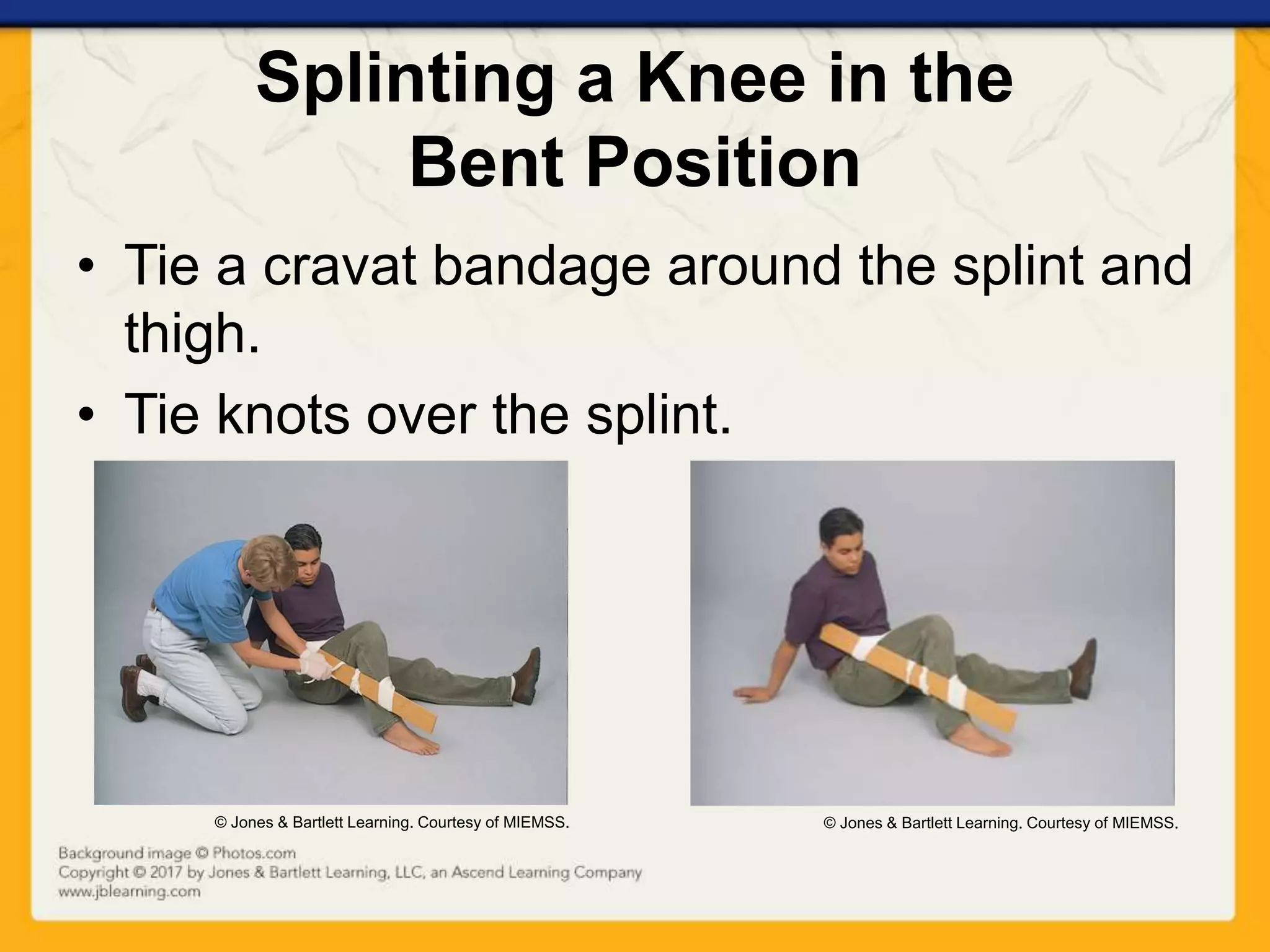 Ch16 presentation splinting_extremities | PPTX