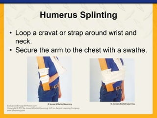 Ch16 presentation splinting_extremities | PPTX