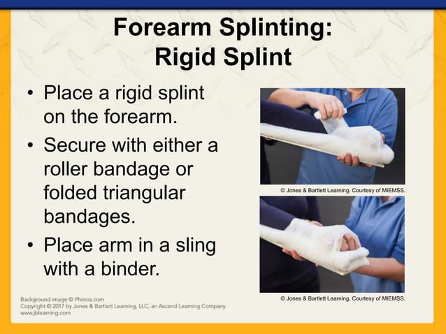 Ch16 presentation splinting_extremities | PPTX | First Aid | Injuries