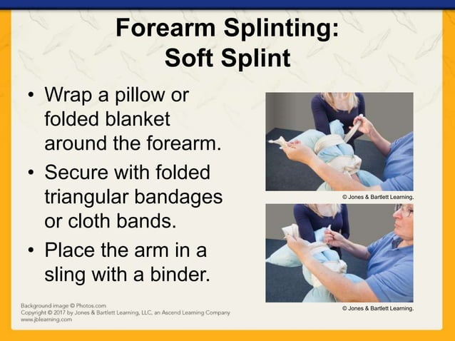 Ch16 presentation splinting_extremities | PPTX | First Aid | Injuries