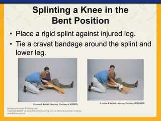 Ch16 presentation splinting_extremities | PPTX
