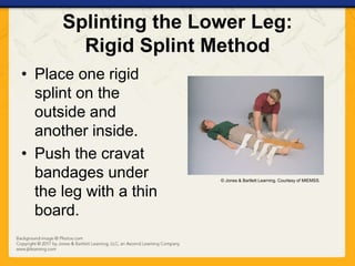 Ch16 presentation splinting_extremities | PPTX