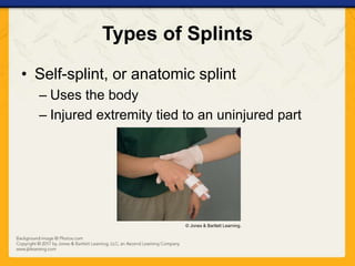 Ch16 presentation splinting_extremities | PPTX