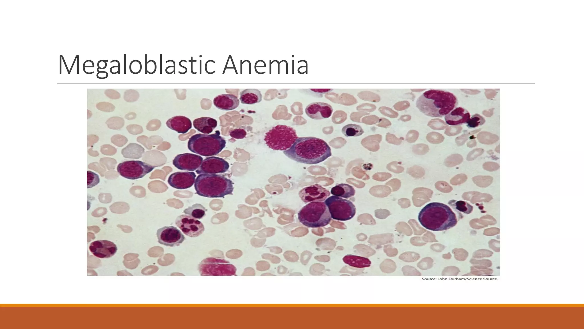 Ch 1 Hematological disorders - Megaloblastic anemia.pdf