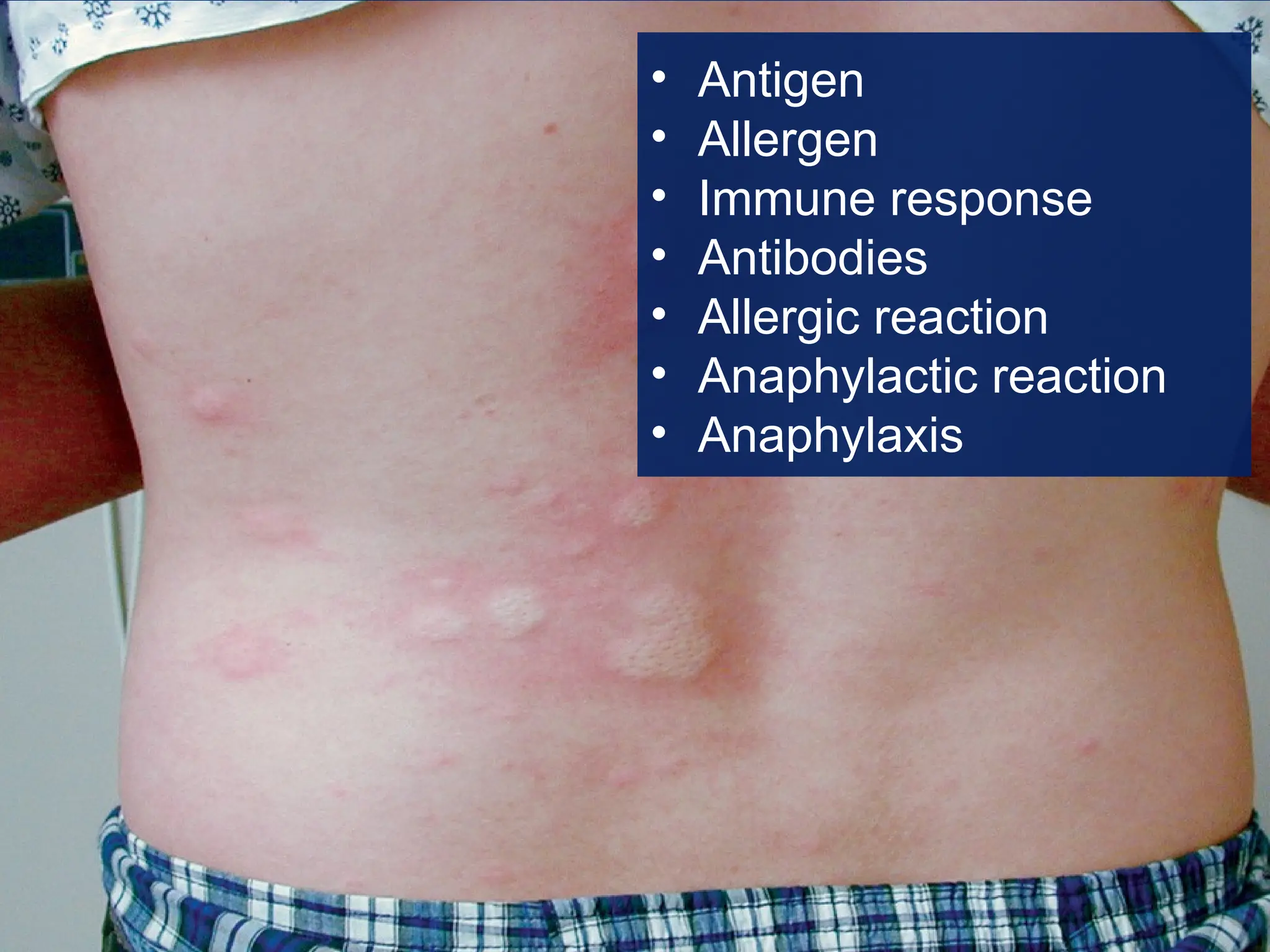 Chapter 21 Anaphylactic Reactions for EMT | PPTX