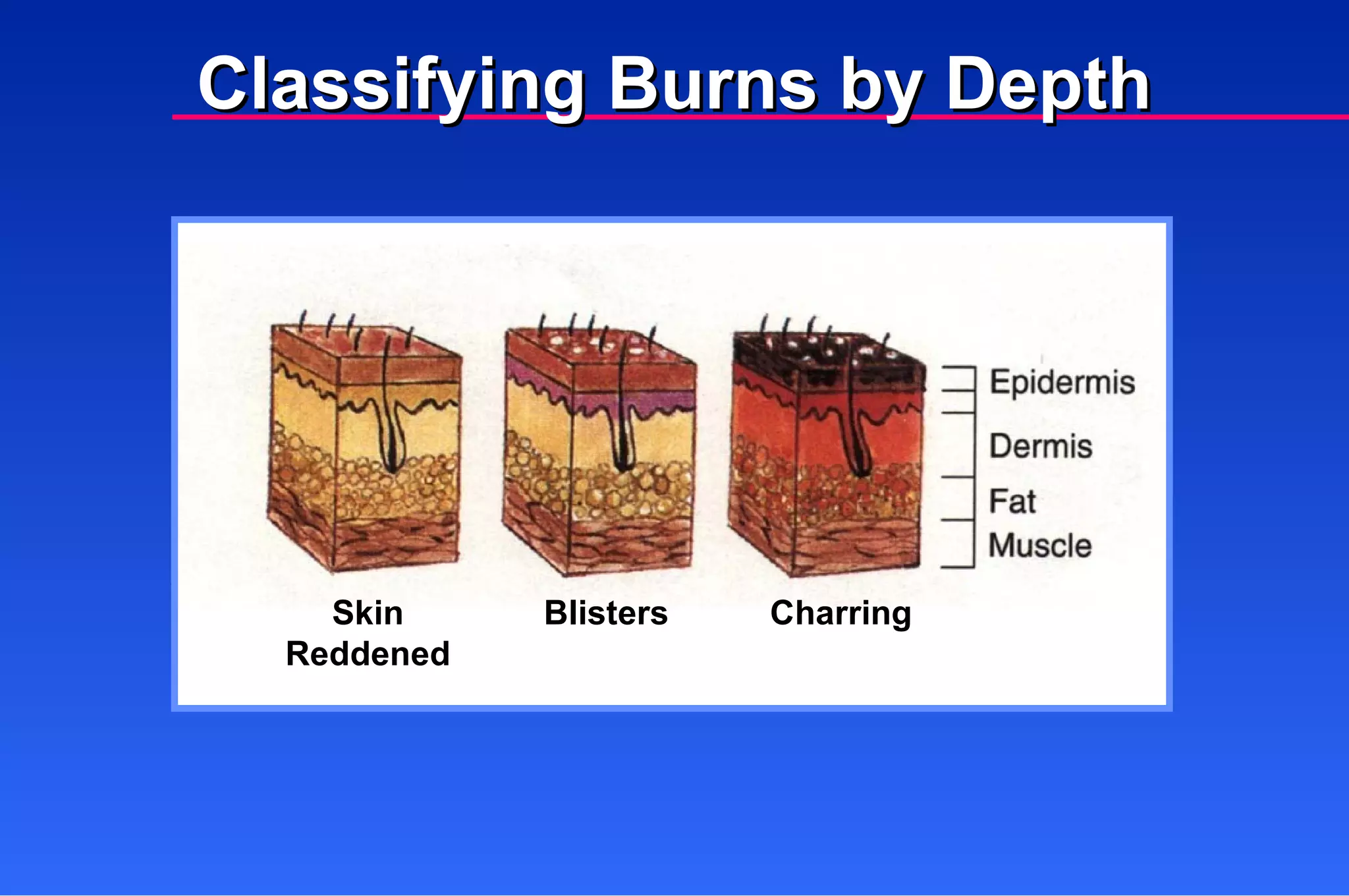 Soft Tissue Injuries | PPT