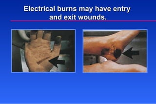 Soft Tissue Injuries | PPT