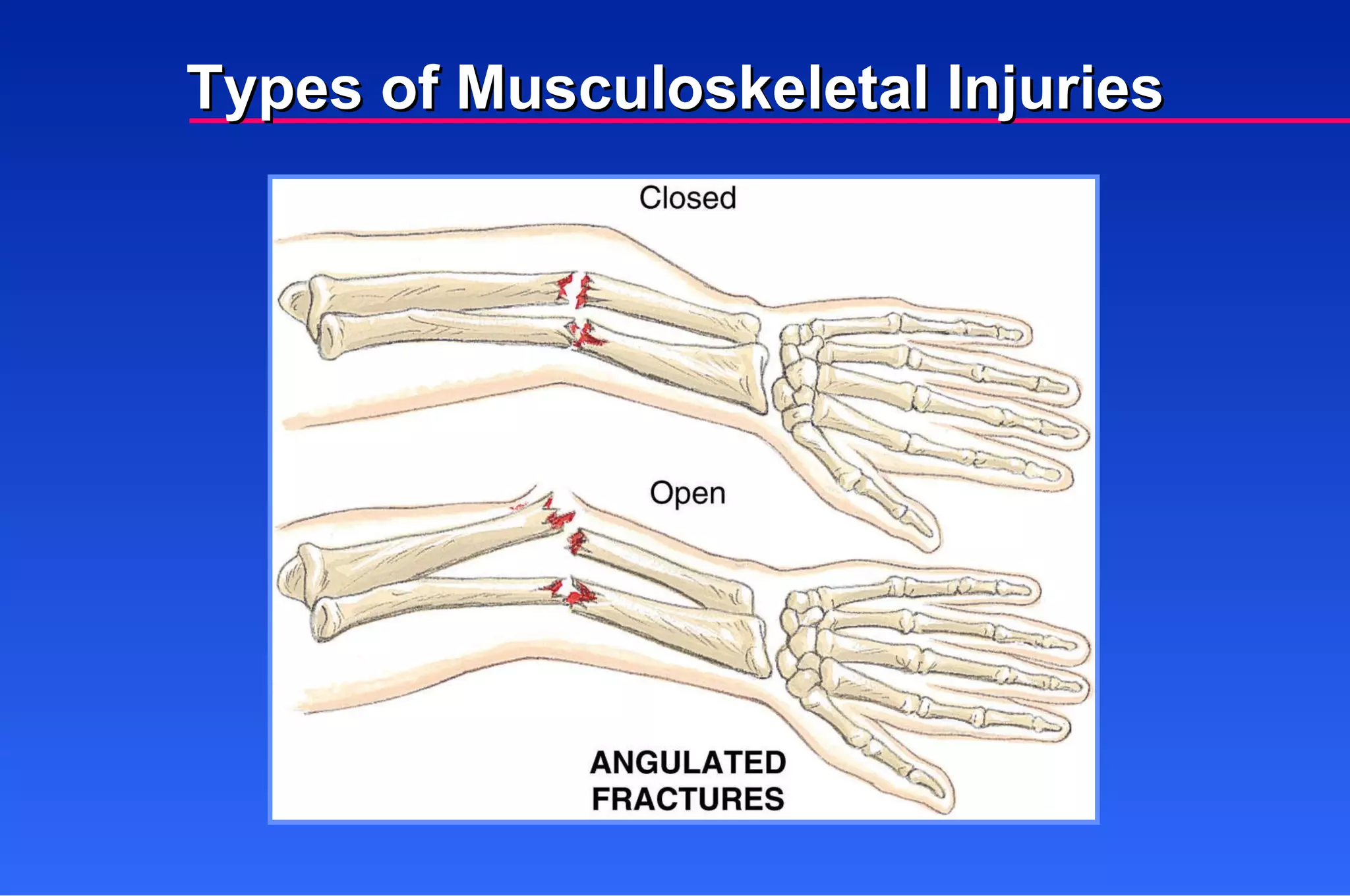 Musculoskeletal Injuries | PPT