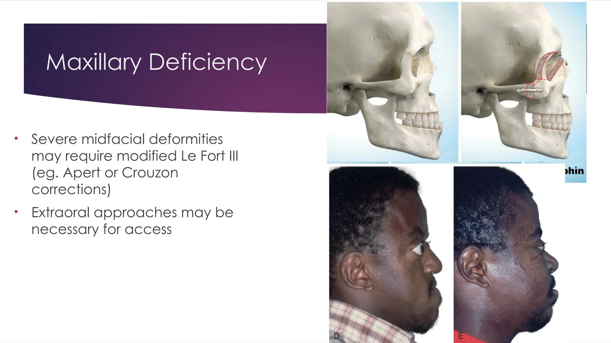 Correction of Dentofacial Deformities by Mari-Alina Timoshchuk.pptx
