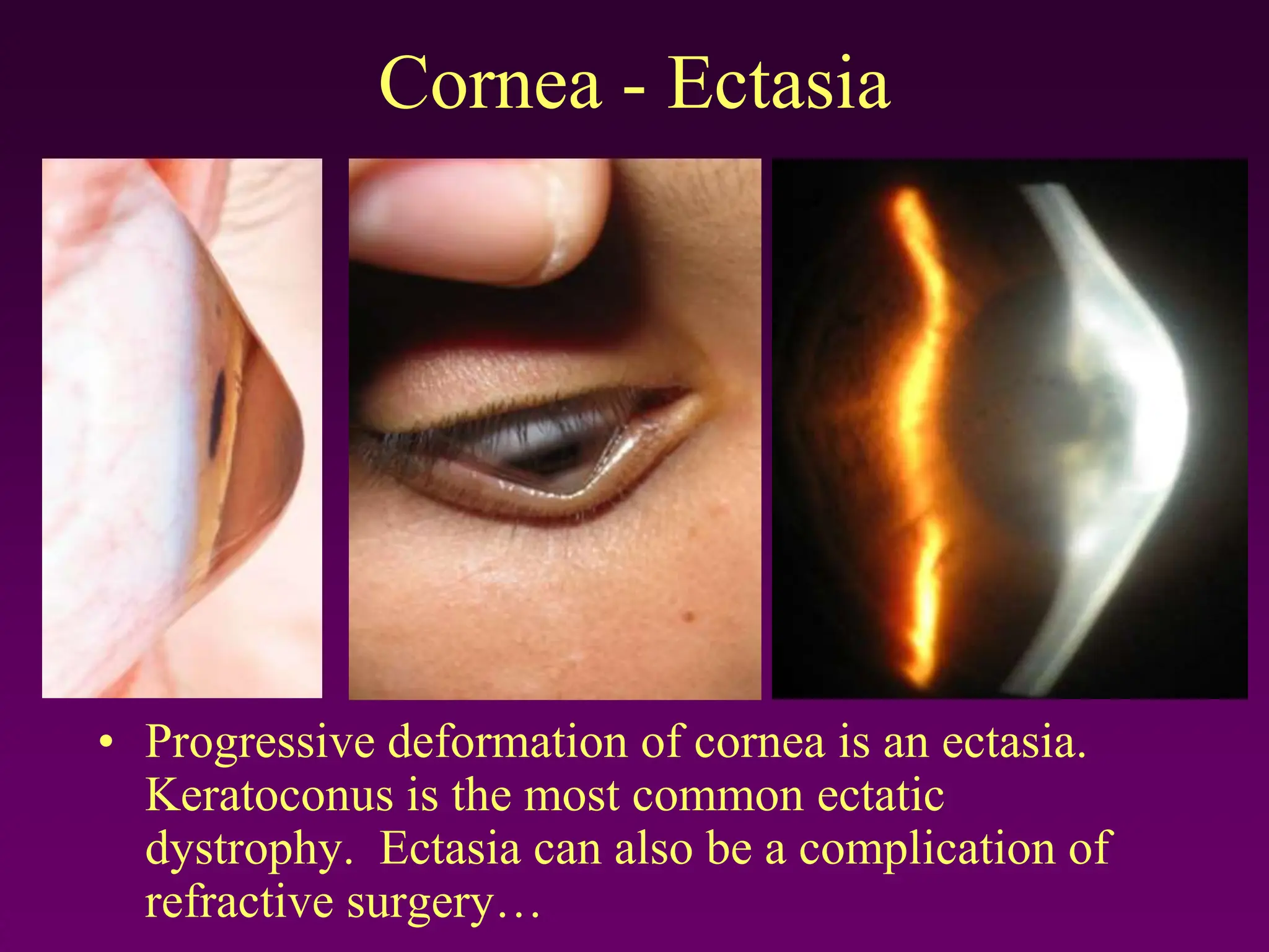 Ch29-Eye pathology of eye..Chapter 19 .ppt