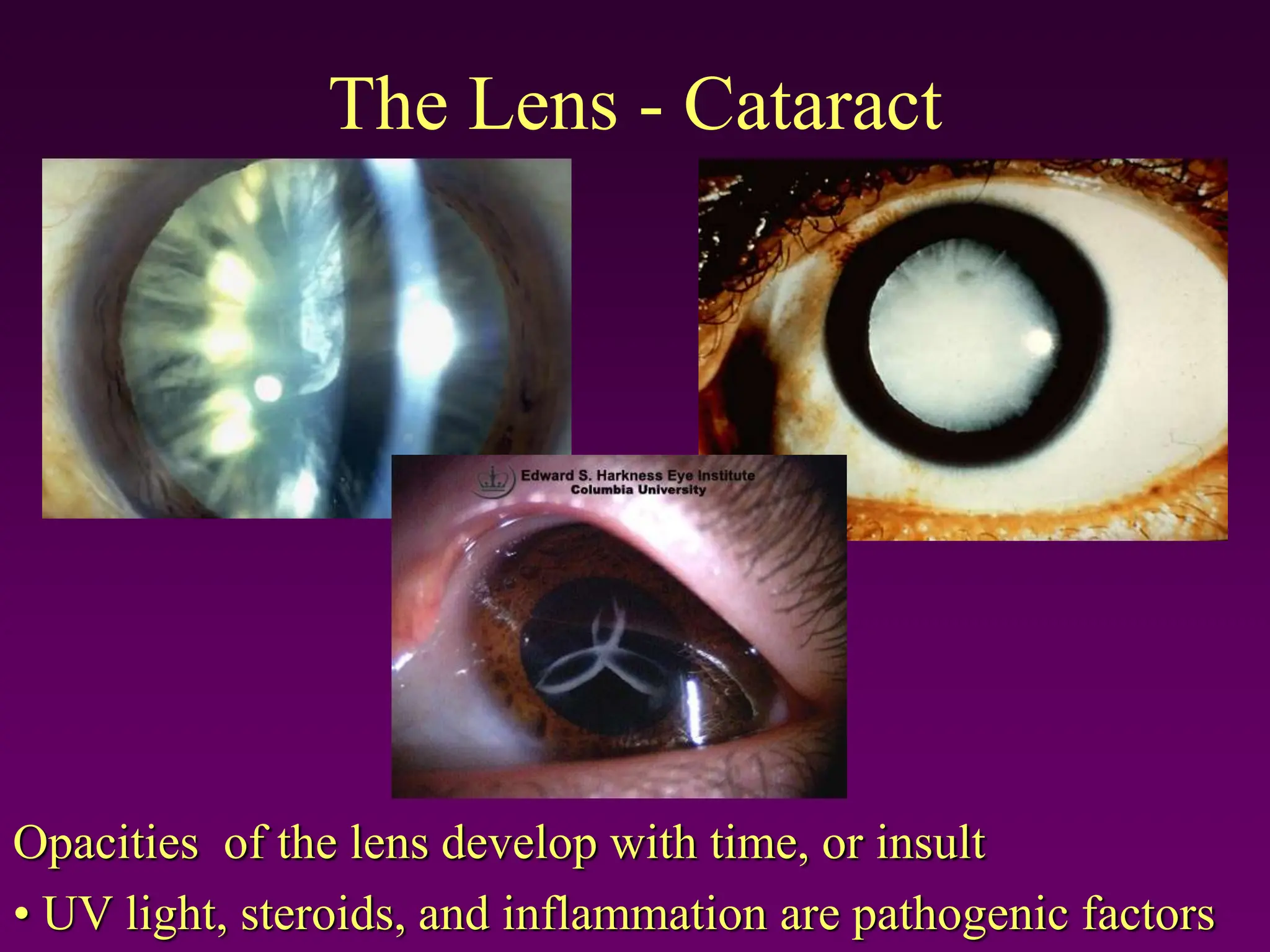 Ch29-Eye pathology of eye..Chapter 19 .ppt