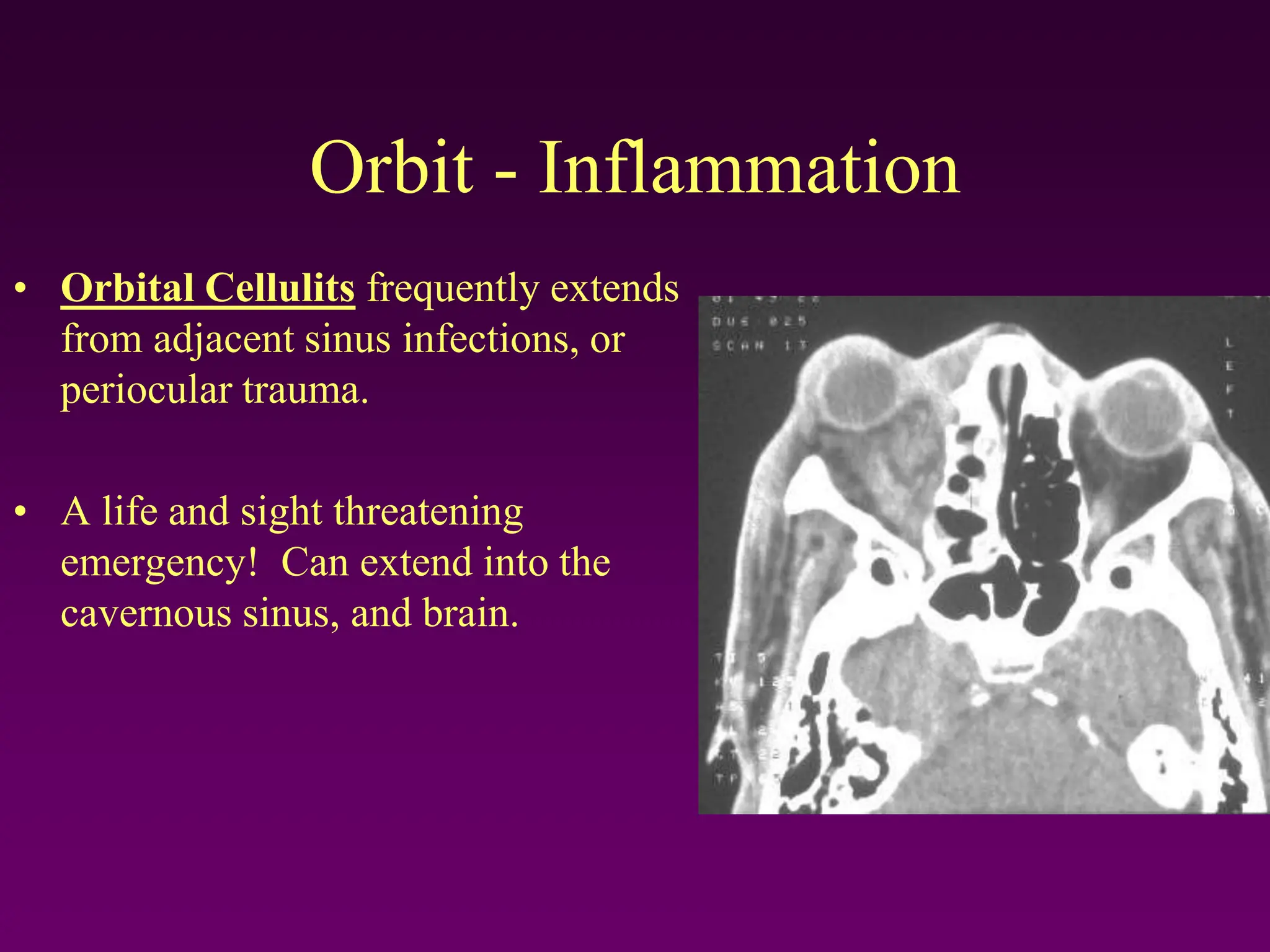 Ch29-Eye pathology of eye..Chapter 19 .ppt