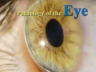 Ch29-Eye pathology of eye..Chapter 19 .ppt