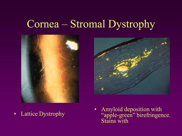 Ch29-Eye pathology of eye..Chapter 19 .ppt