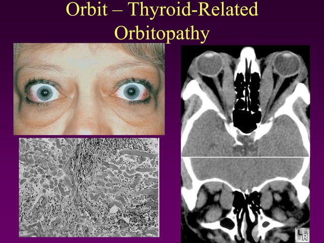 Ch29-Eye pathology of eye..Chapter 19 .ppt