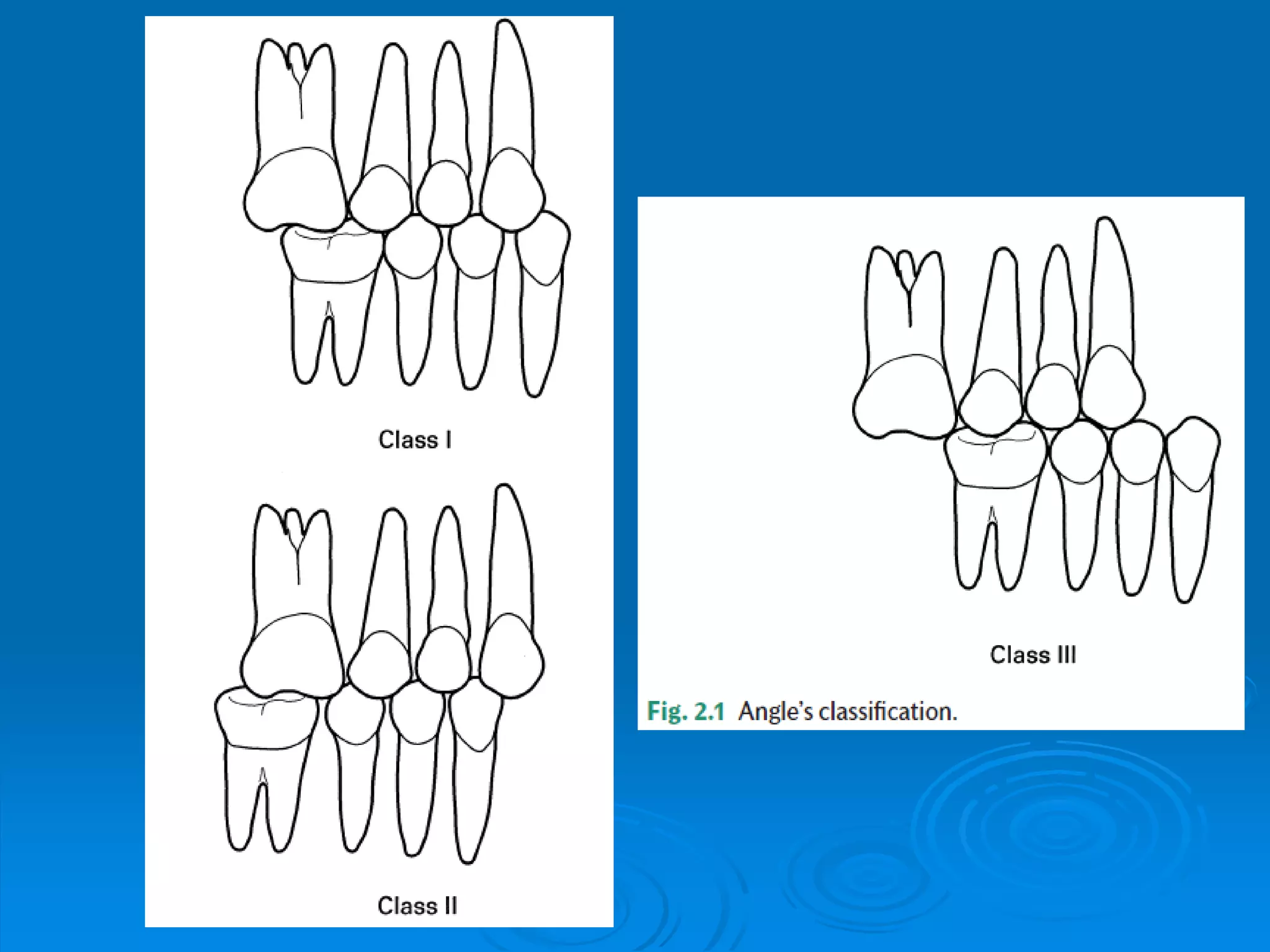 Ch2 lec2 orthodontics "Classifications " | PDF