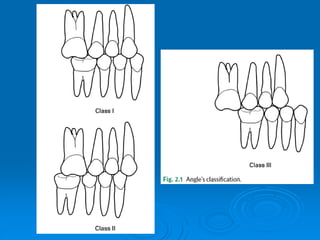 Ch2 lec2 orthodontics "Classifications " | PDF