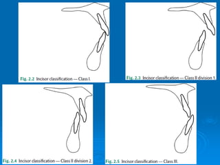 Ch2 lec2 orthodontics "Classifications " | PDF