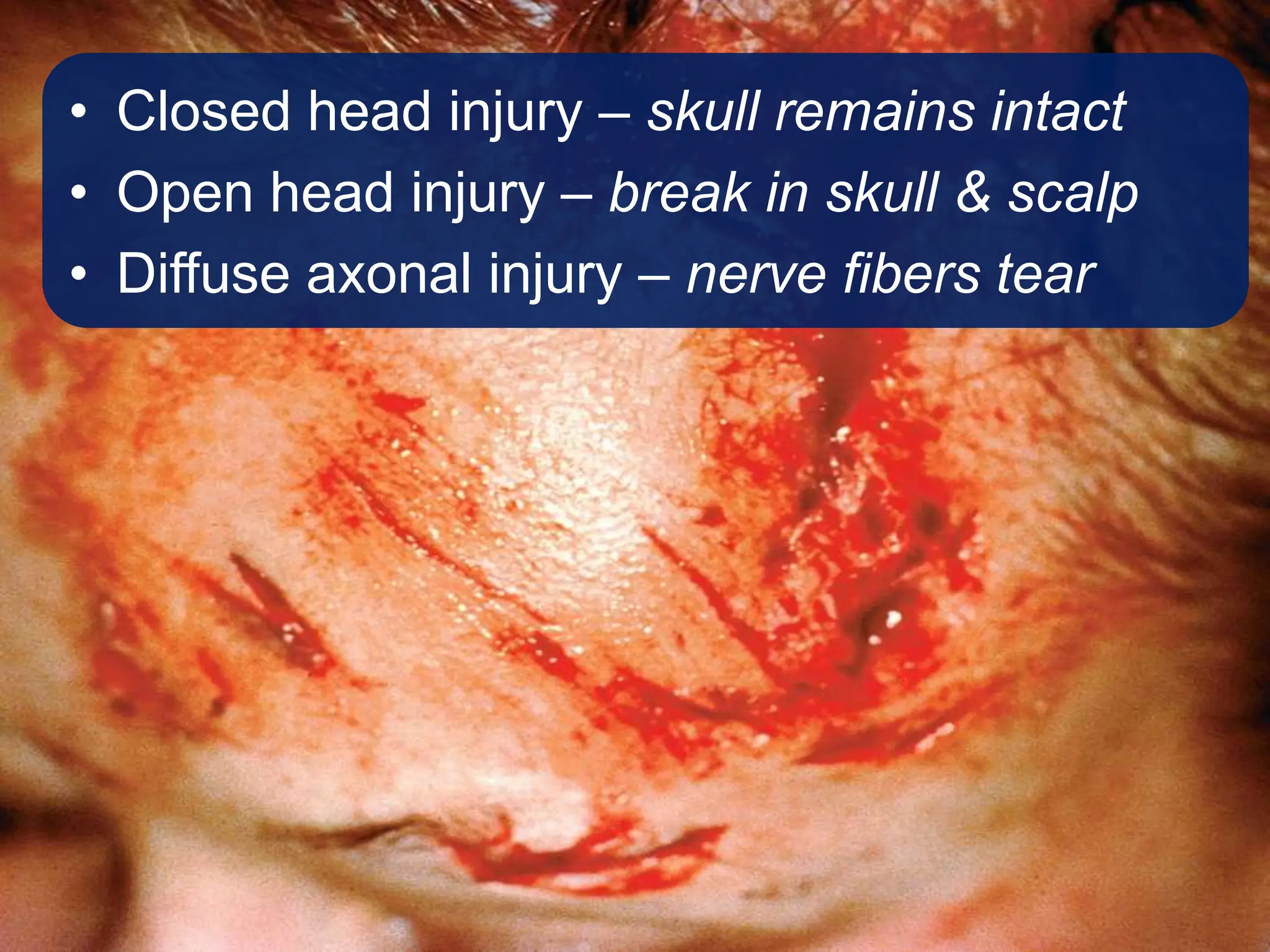 Chapter 31 Head Trauma.ppt