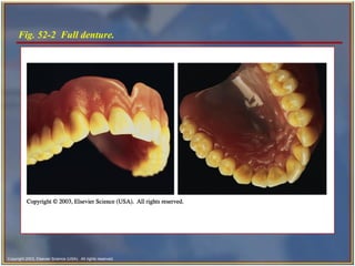 Ch52 removable prosthodontics | PPT