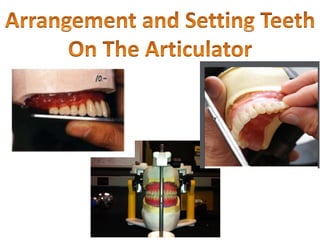 arrangement and setting teeth on the articulator | PPT