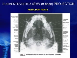 Extraoral radiography | PPTX