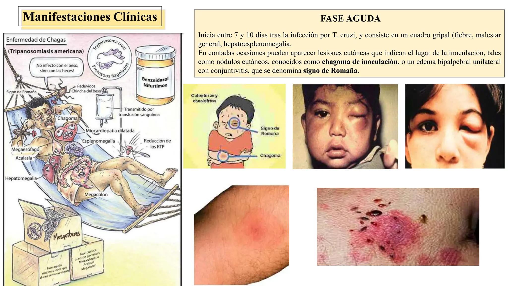 Enfermedad Del Chagas Generalidades P Pptx