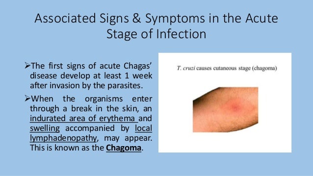 Chagas Disease (American Trypanosomiasis)
