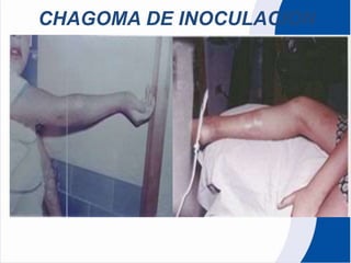 Chagas generalidades epidemiologia ciclo vital clinica dx tratamiento y ...