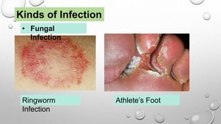 Chain of Infection ppt: lecture for Funda 1 | PPTX