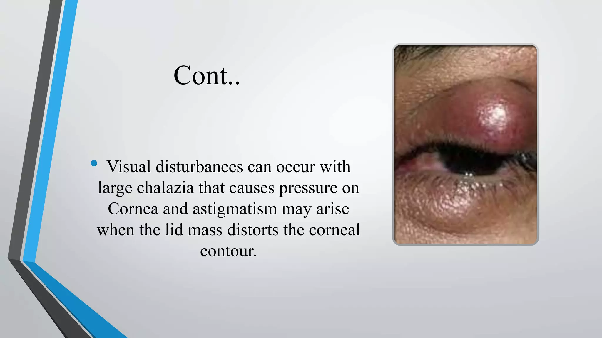 Chalazion | PPTX