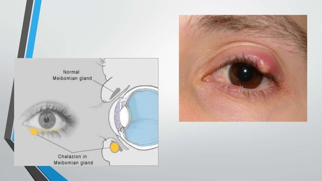 Chalazion | PPTX