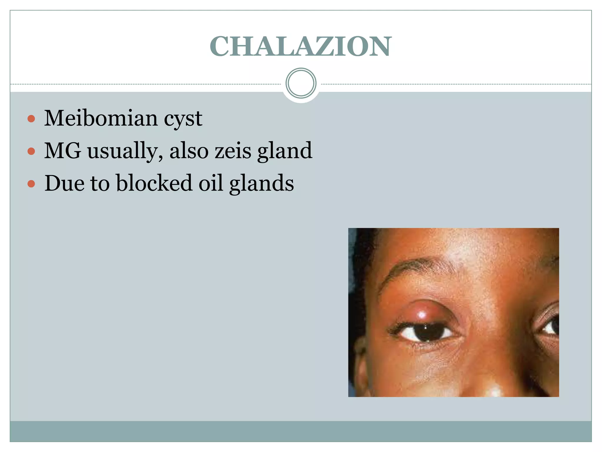 Chalazion | PPTX