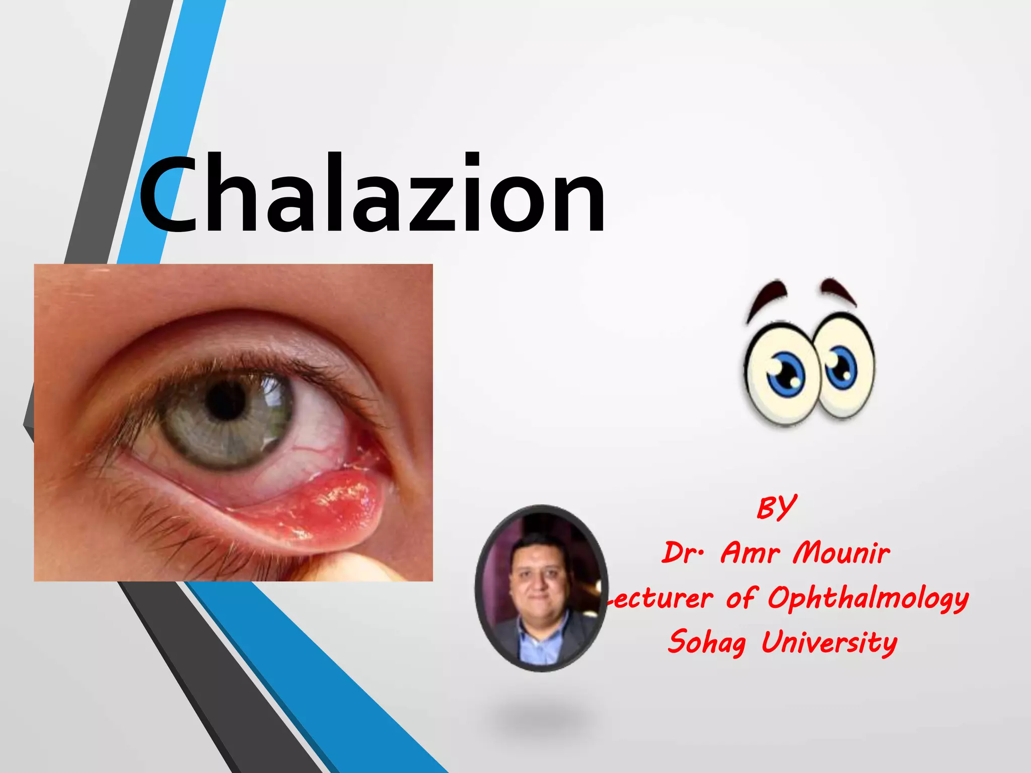 Chalazion | PPTX