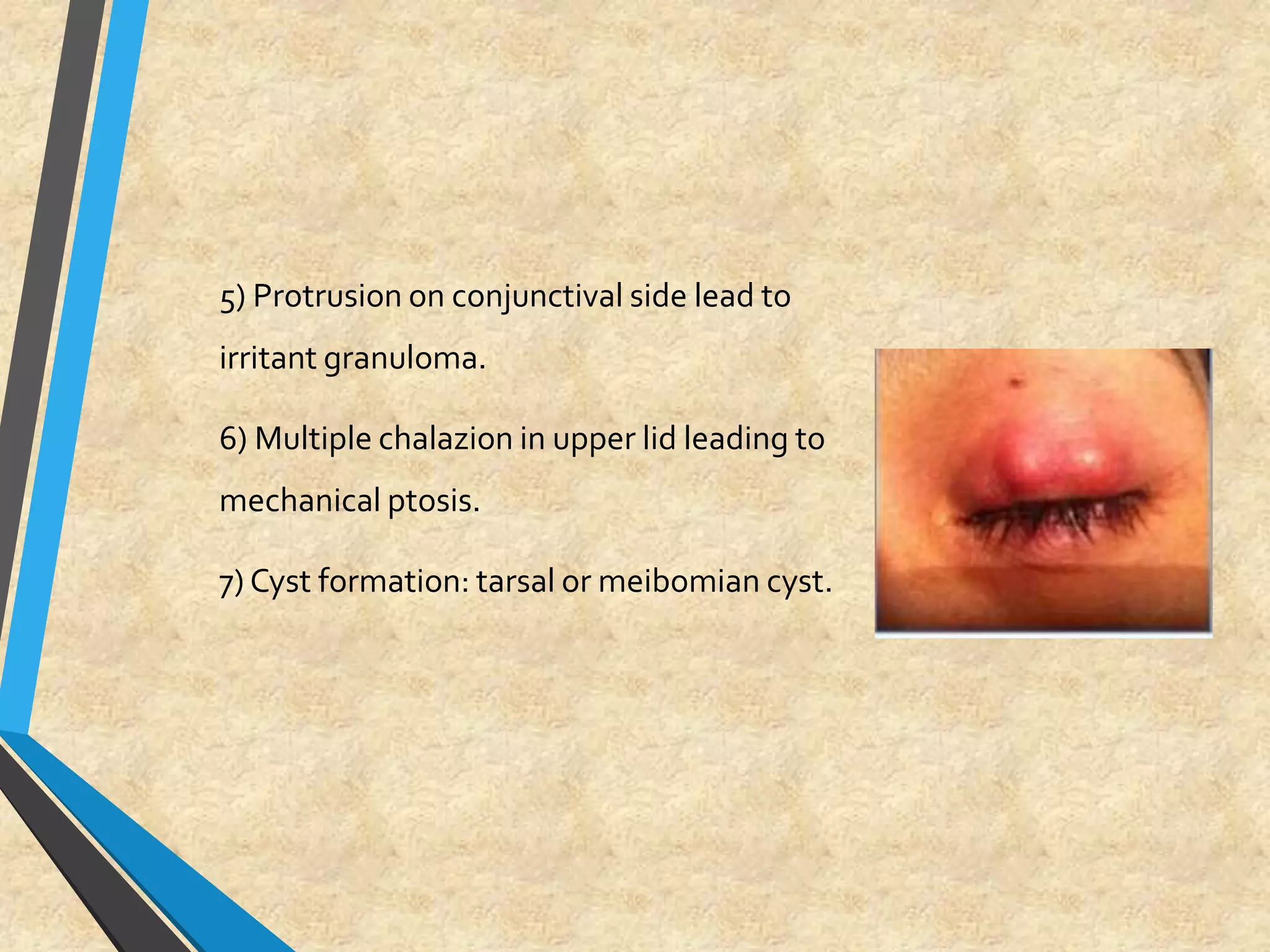 Chalazion | PPTX