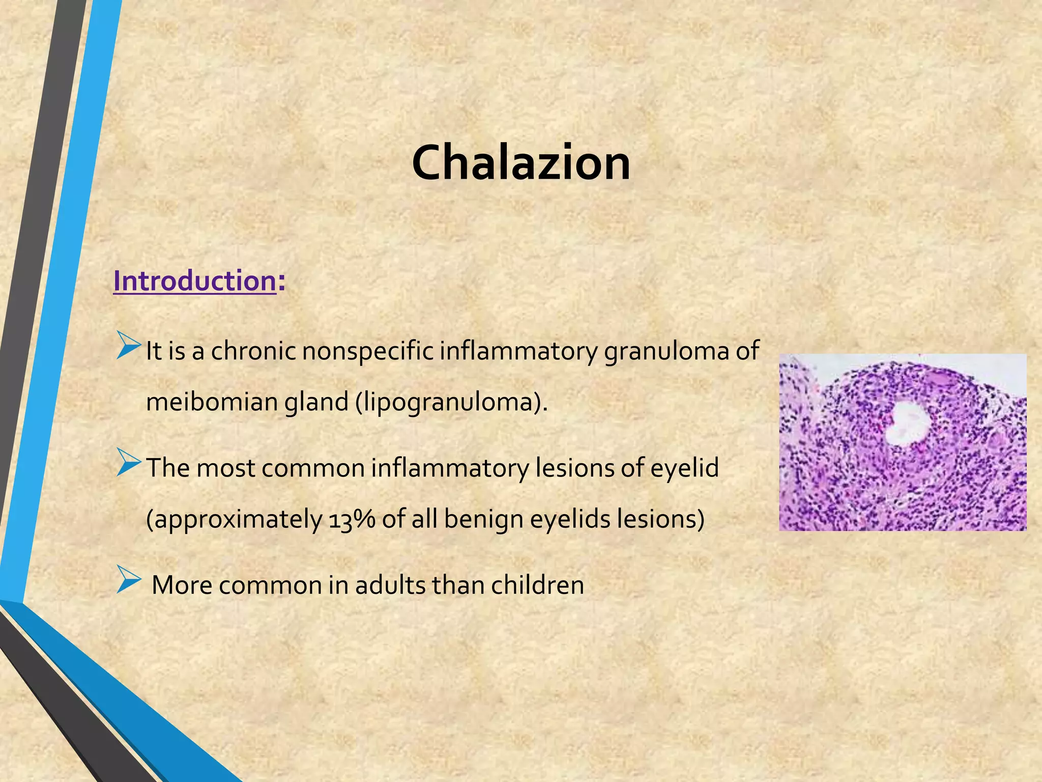 Chalazion | PPTX