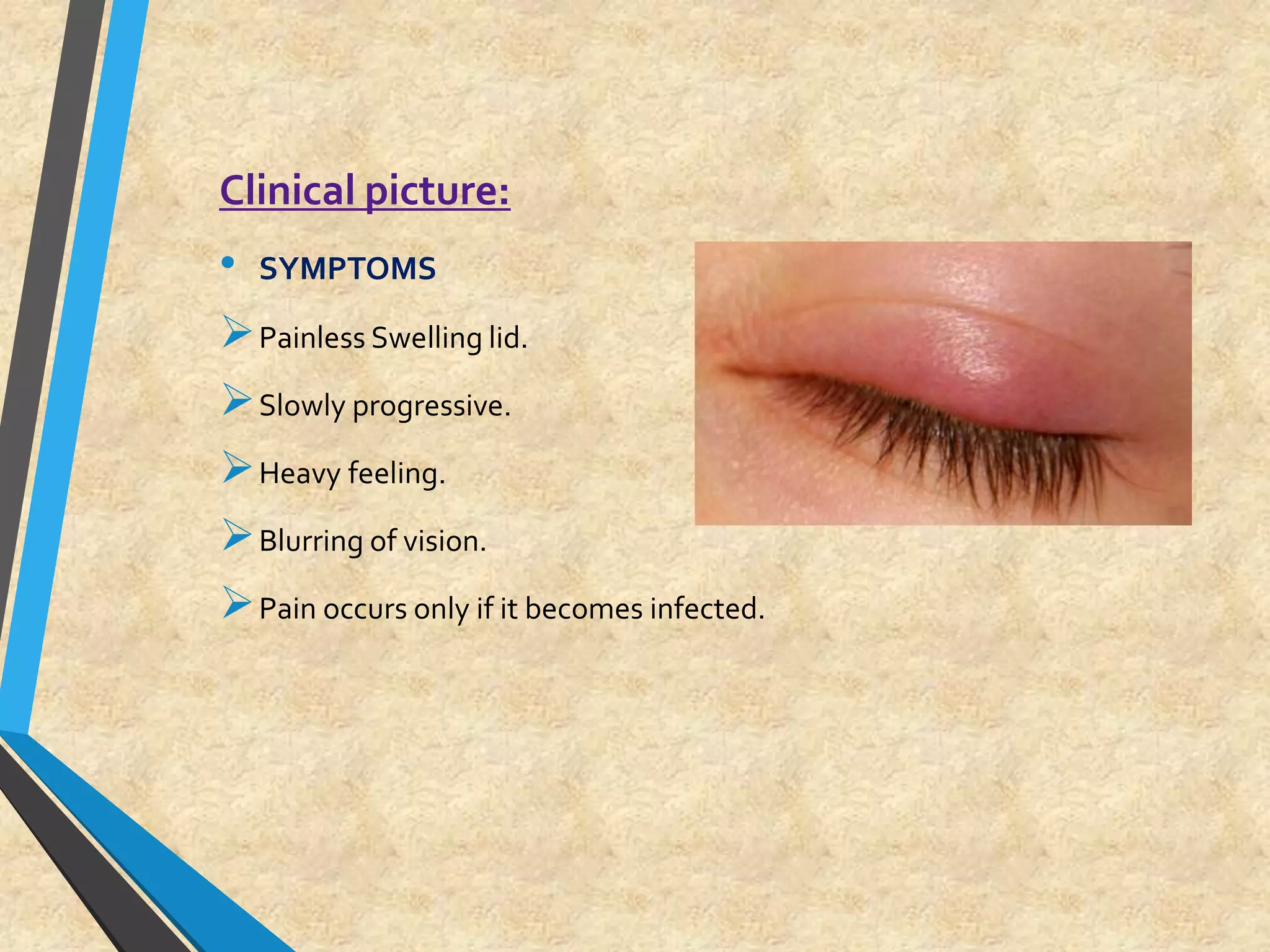 Chalazion | PPTX