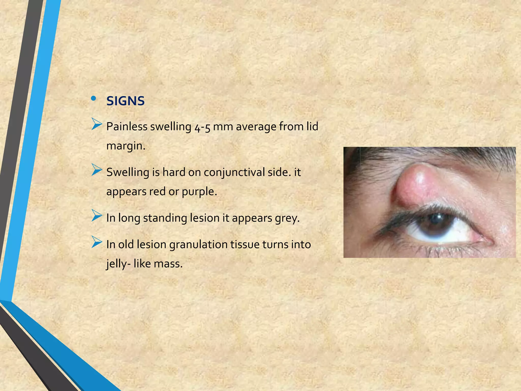 Chalazion | PPTX
