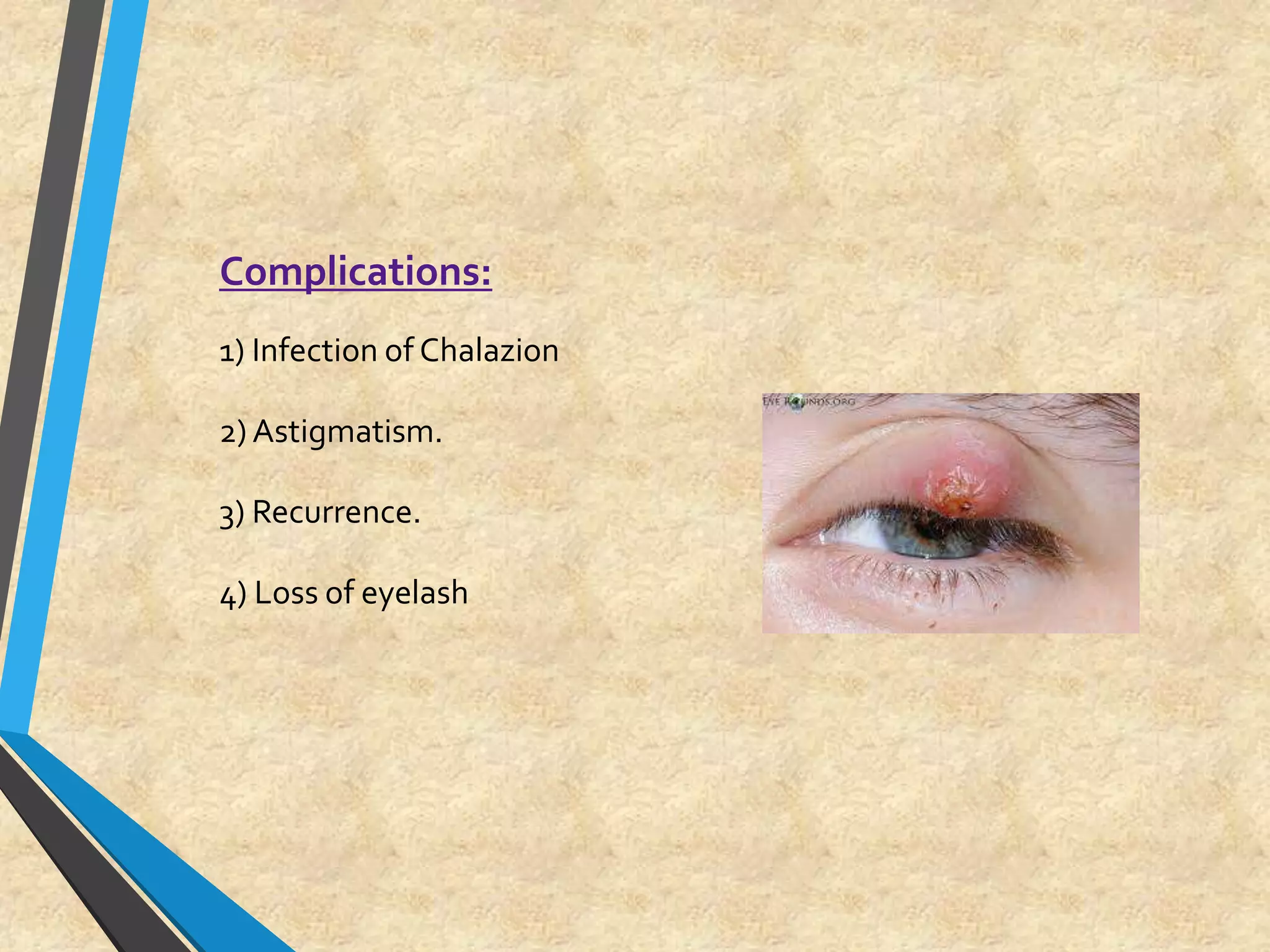 Chalazion | PPTX